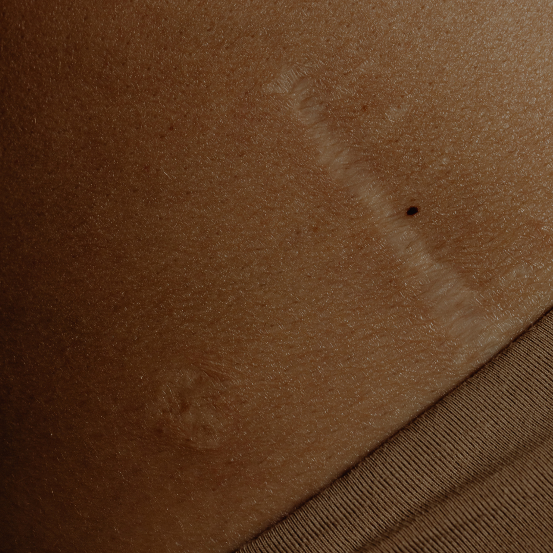 Top Methods for Minimizing Scarring – Barrett Recovery